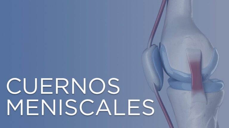 Meniscopatía Grado 3 del Cuerno Posterior del Menisco Medial: Causas ...