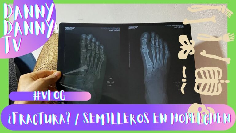 ¿Qué Hacer si Te Cayó una Pesa en el Pie? Consejos y Primeros Auxilios ...